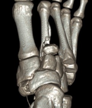 High energy Lisfranc fracture dislocations | The Bone School